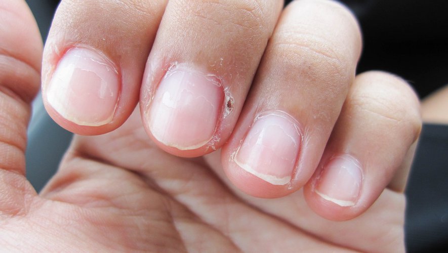 Panaris que faire ? Solution pour traiter le panaris efficacement ...